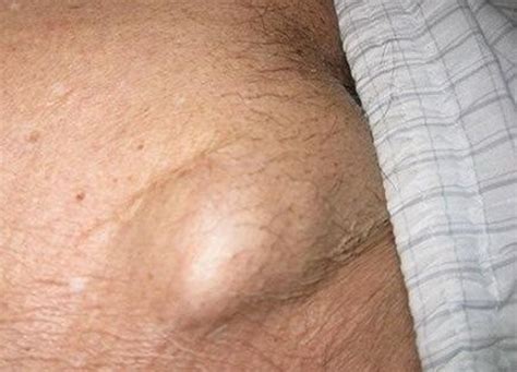Dương Vật Nổi Hạch Là Bị Làm Sao Cách điều Trị Hiệu Quả Bệnh Viện