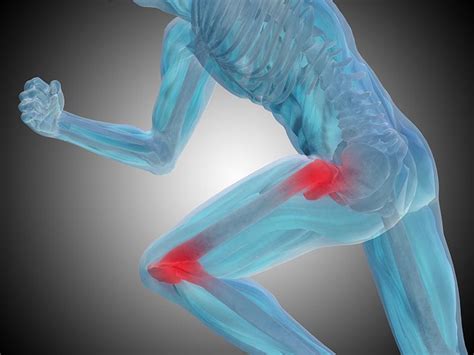 Statin Use Tied To Joint Replacement Risk Multidisciplinary Mims