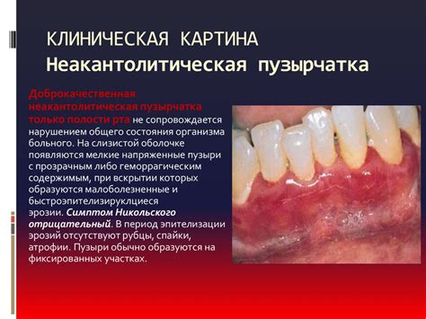 Пузырчатка Этиология Патогенез Клиническая картина Гистопатология