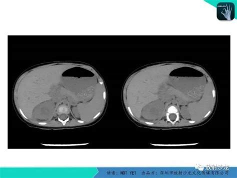 【病例】肾脓肿1例ct影像表现 影像ppt