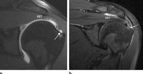 Supraspinatus Tear Mri