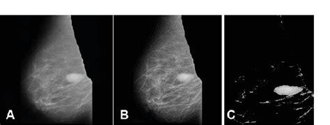 Figure 4 From A Model For Mammogram Image Segmentation Based On Hybrid Enhancement Semantic
