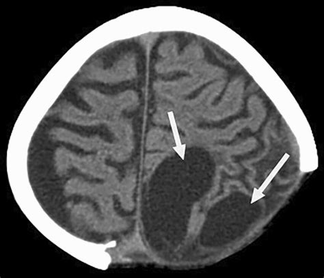 Axial Brain Nonenhanced CT Scan In Parenchymal Window Showing Two