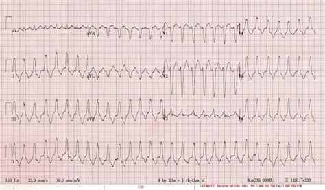Killer Ecg Patterns • Litfl Medical Blog • Ecg Library