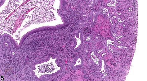 Uterus Endometrium Metaplasia Squamous Nonneoplastic Lesion Atlas