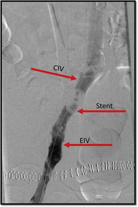 Completion Venography Demonstrating Patent Iliac Vein Stent The Arrows