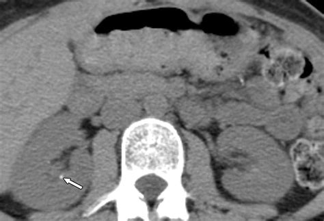 Nonobstructing Renal Stones On Unenhanced Ct A Real Cause For Renal Colic Ajr