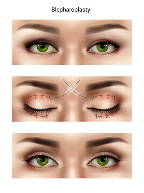 Brow Lift Vs Blepharoplasty Deciphering The Differences Wellbeing