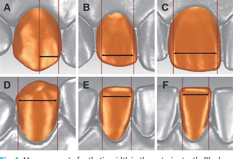 Figure 4 From Biometry Of Width Between Labial Transitional Line Angles