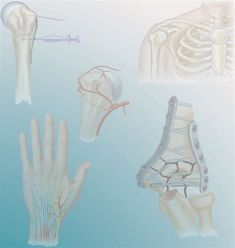 15 Scaphoid Fracture Fixation Musculoskeletal Key
