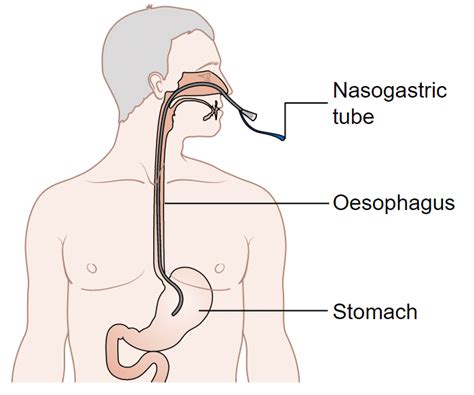 Bowel Obstruction Causes Management Teachmesurgery