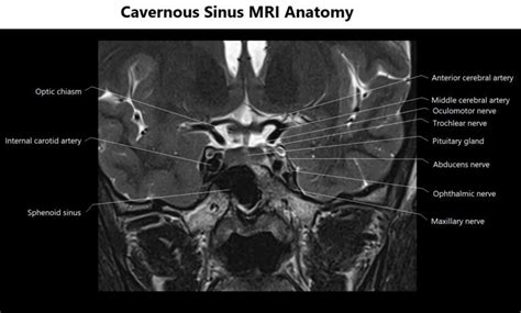 Cavernous Sinus Mri Mri Cavernous Sinus Protocol And Planning