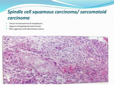 Tumors And Tumor Like Conditions Of Nasal Cavity