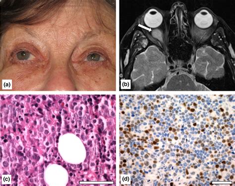 Ocular Adnexal Lymphoma Subtype‐specific Clinical And Genetic Features