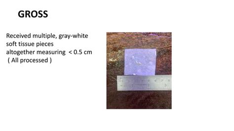 Surgery Pathology Meet Adenocarcinoma Ppt Ppt