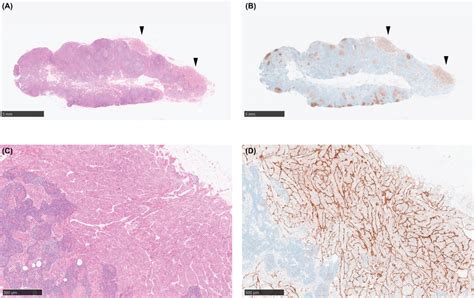 Nodal Lymphangioleiomyomatosis Lam In A Common Iliac Lymph Node A