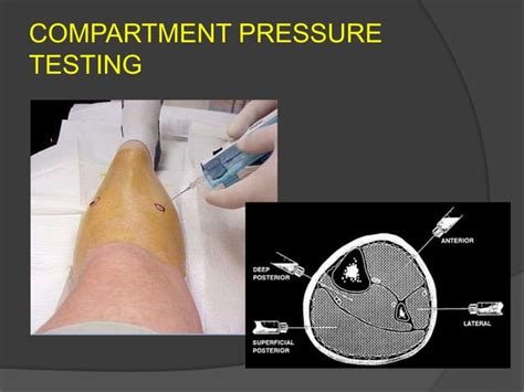 Chronic Exertional Compartment Syndrome University Of Florida Ppt