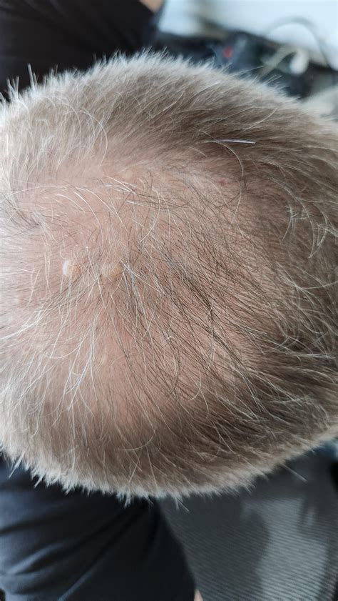 Pimple Bumps On Scalp R Dermatologyquestions