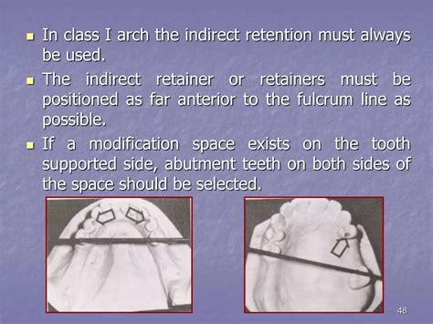 Principles Of Rpd Design Ppt