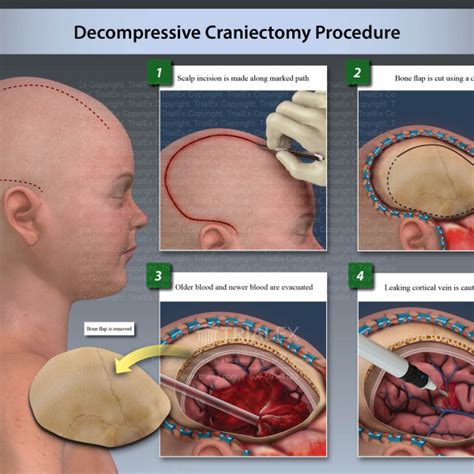 Medical Legal Exhibits Legal Animations And Trial Graphics Tria