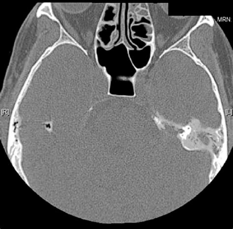 E Ct Scan Of Grade Ii Disease Involving The Right Mastoid Process