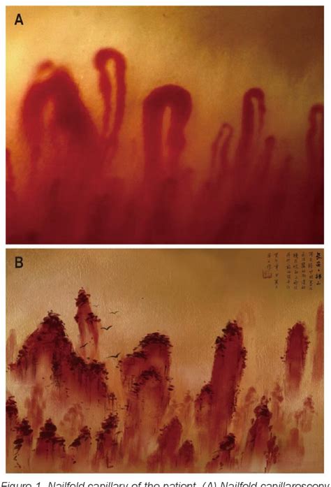 Active Pattern On Nailfold Capillaroscopy In A Patient With Systemic