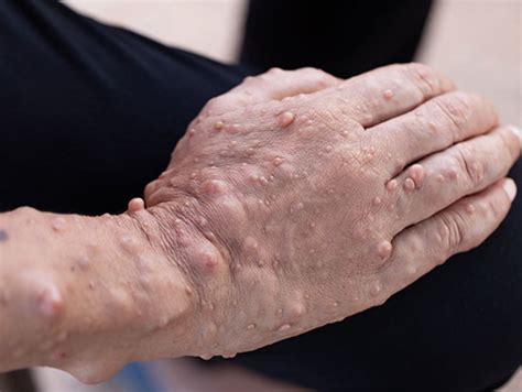 Mild Neurofibromatosis