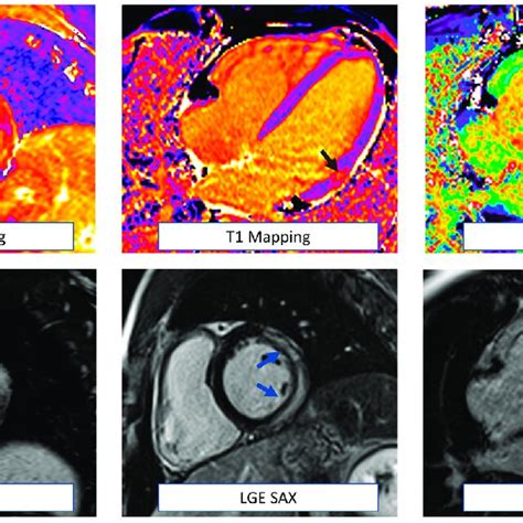 Cmr In Myocarditis Cmr Is Particularly Helpful In Diagnosing Immune