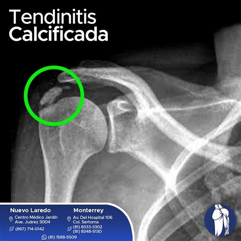 La Tendinitis Calcificada O Cálcica De Hombro Es Una Causa Frecuente De