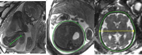Fetal Biometry For Using Hadlocks Weight Estimation Formulas Three