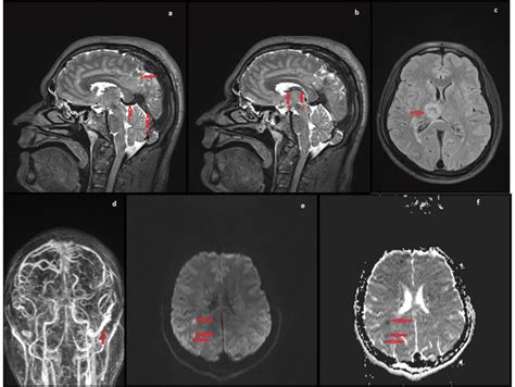 Mri Revealed 1 Galen Vein 2 Straight Sinus 3 Superior Sagittal