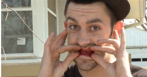 Dentist Pulls All Of Mans Teeth Out Without Permission Patient Says