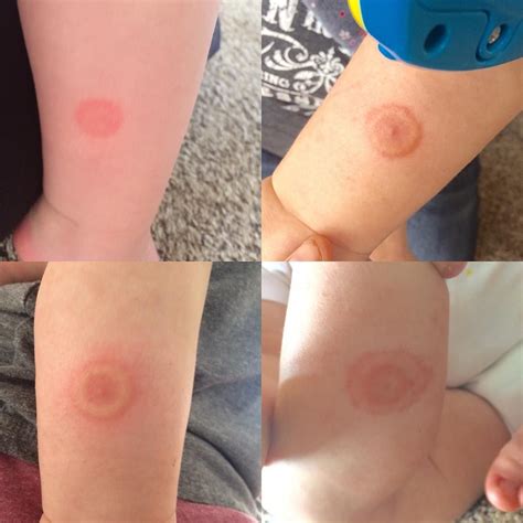 How To Treat A Tick Bite Tick Bite Tick Bites Pictures Tick Bite