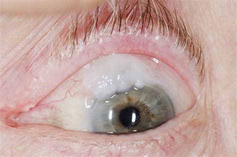 Eye Bleb After Eye Surgery Stock Image C0168227 Science Photo