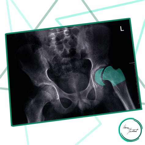 Slipped Upper Femoral Epiphysis Sufe