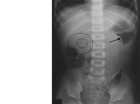 Intussusception In Adults Submucosal Lipoma At Transverse Colon A Rare
