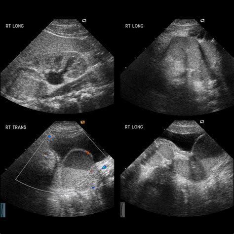 Pediatric Acute Pyelonephritis Pediatric Radiology Reference Article