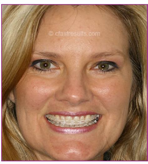 Cfast Quick Braces One Dental Care Cosmetic Dentists In Dalry Kilbirnie And Beith