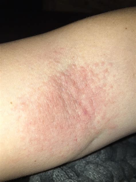 Developing A Rash On My Arm Inside Part Where It Bends Rozempic