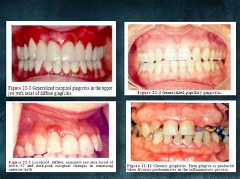 Clinical Features Of Gingivitis And Its Correlation With Microscopic