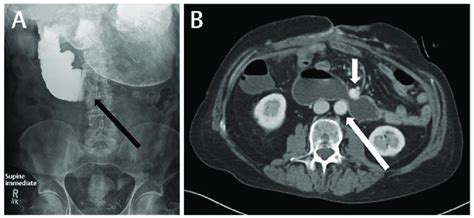Sma Like Syndrome Due To Compression By The Smv And The Aorta A