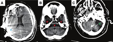 Beam Hardening Artifact Ct Brain Home Design Ideas