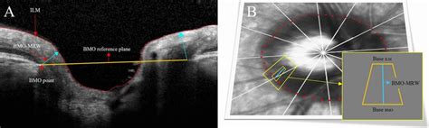 Optic Nerve Head Analysis Using Spectral Domain Optical Coherence Download Scientific Diagram