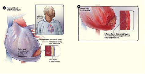 NCLEX Cardiac Points Pericarditis NCLEX Quiz