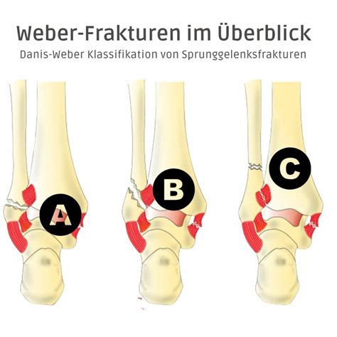 Weber A B C Fraktur Heilung Reha And Übungen Im Überblick