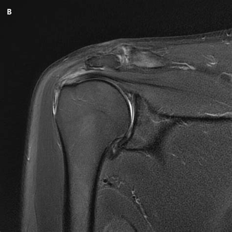A Preoperative Plain Anteroposterior Radiograph Acromioclavicular