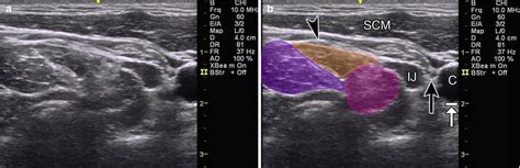 Trigger Point Injections Radiology Key