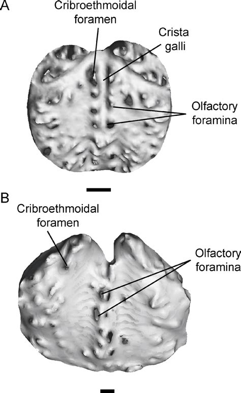 3 Digital Renderings Of The Cribriform Plate Showing The Presence Or