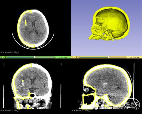 20ml基底节脑出血如何治疗？ 脑医汇