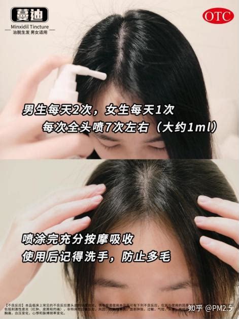 女生脱发求解：蔓迪米诺地尔酊女生能用吗？ 知乎